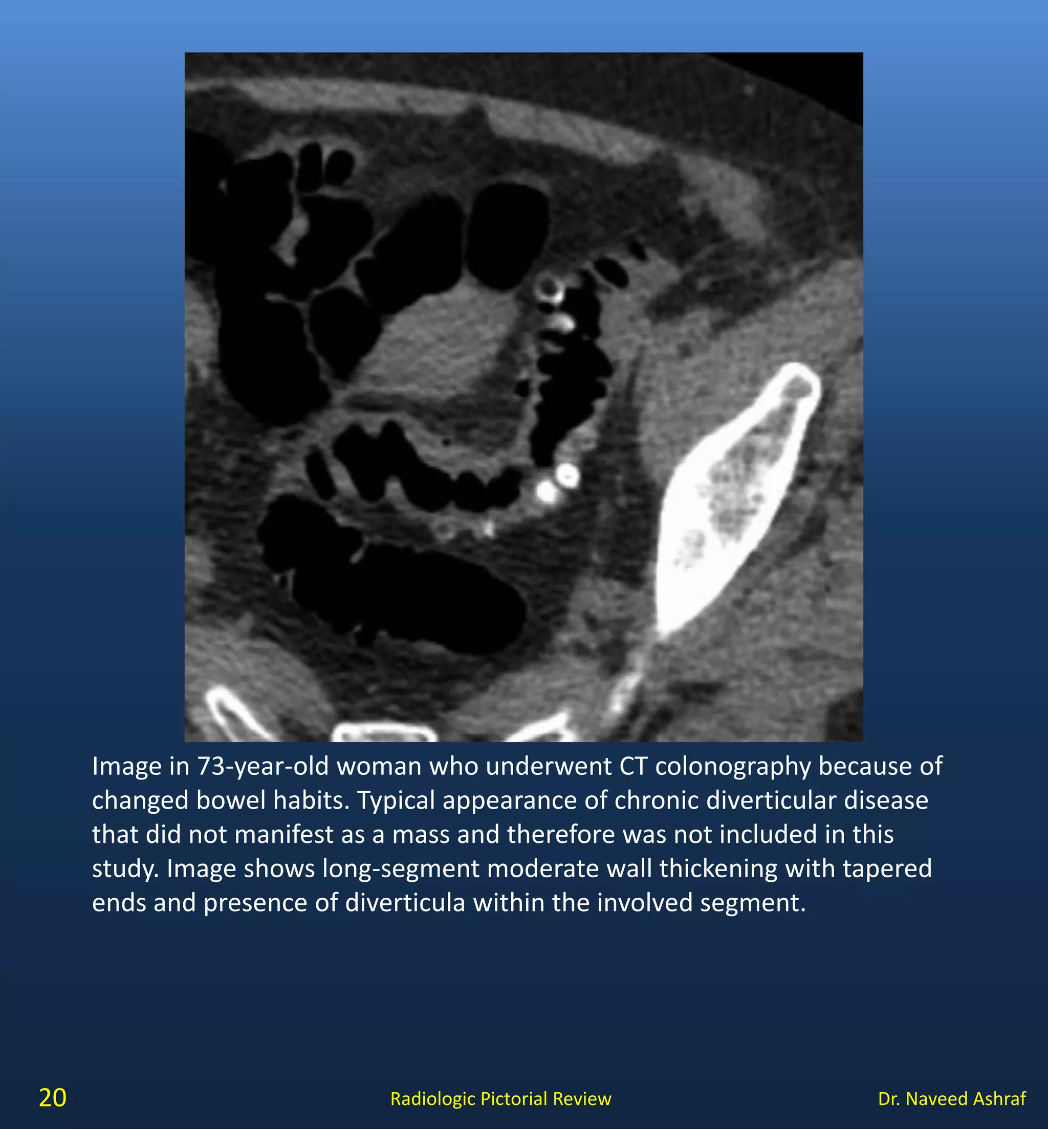 Diverticular disease v/s Carcinoma | PDF