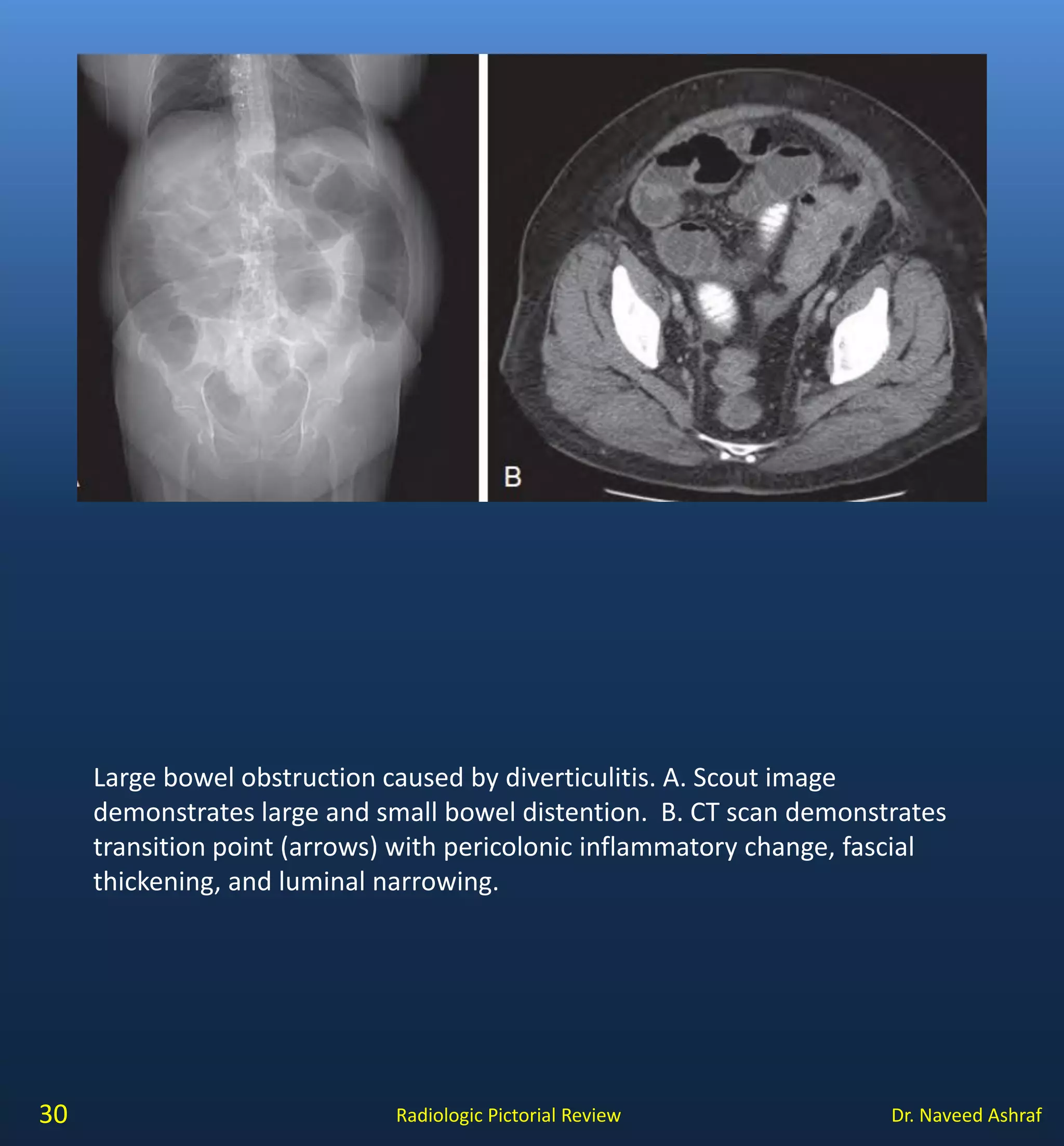 Diverticular disease v/s Carcinoma | PDF