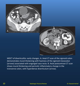 Diverticular disease v/s Carcinoma | PDF