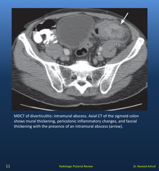 Diverticular disease v/s Carcinoma | PDF