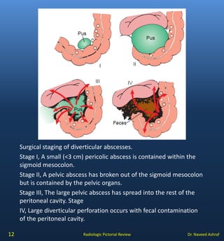 Diverticular disease v/s Carcinoma | PDF