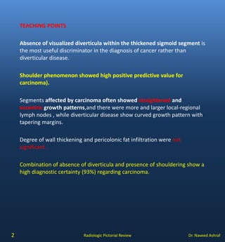 Diverticular disease v/s Carcinoma | PDF