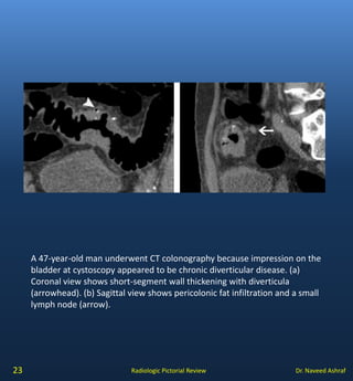 Diverticular disease v/s Carcinoma | PDF