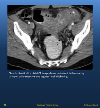 Diverticular disease v/s Carcinoma | PDF