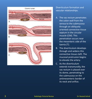 Diverticular disease v/s Carcinoma | PDF