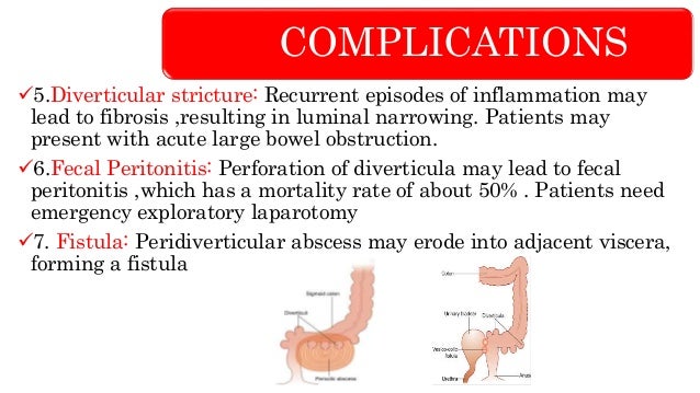 Diverticular Disease-Lower GI Hemorrhage