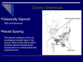 Diverticular disease of colon | PPT