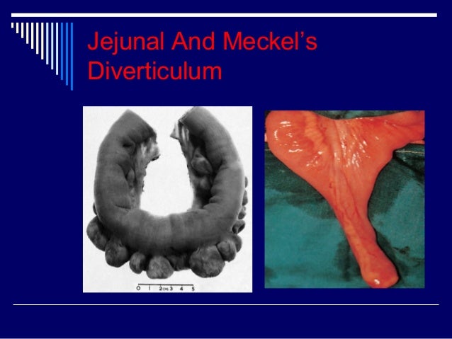 Diverticular disease of colon