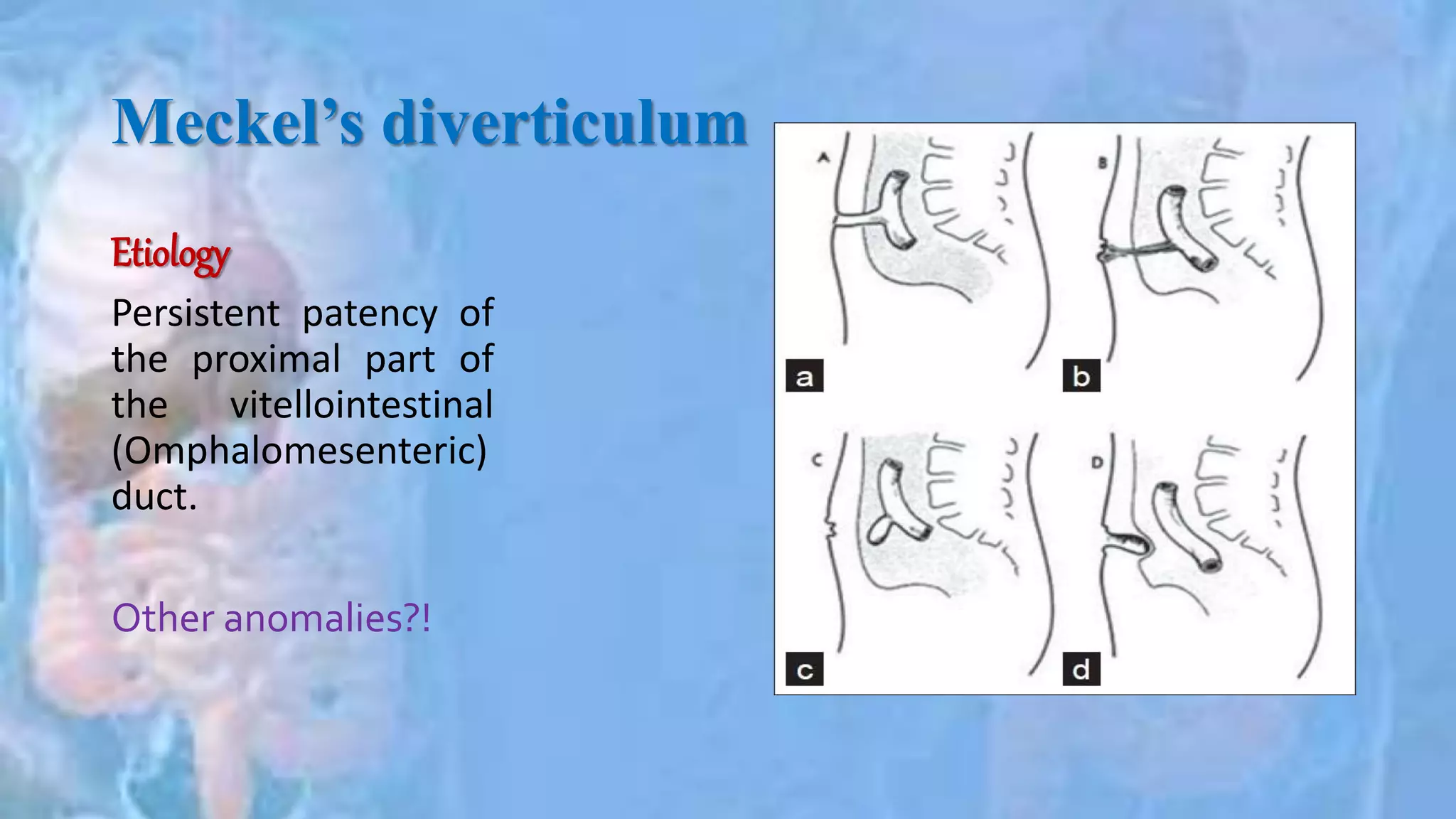 Diverticular disease of git | PPTX