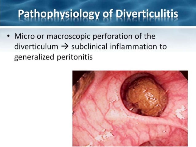 Diverticular disease of the colon