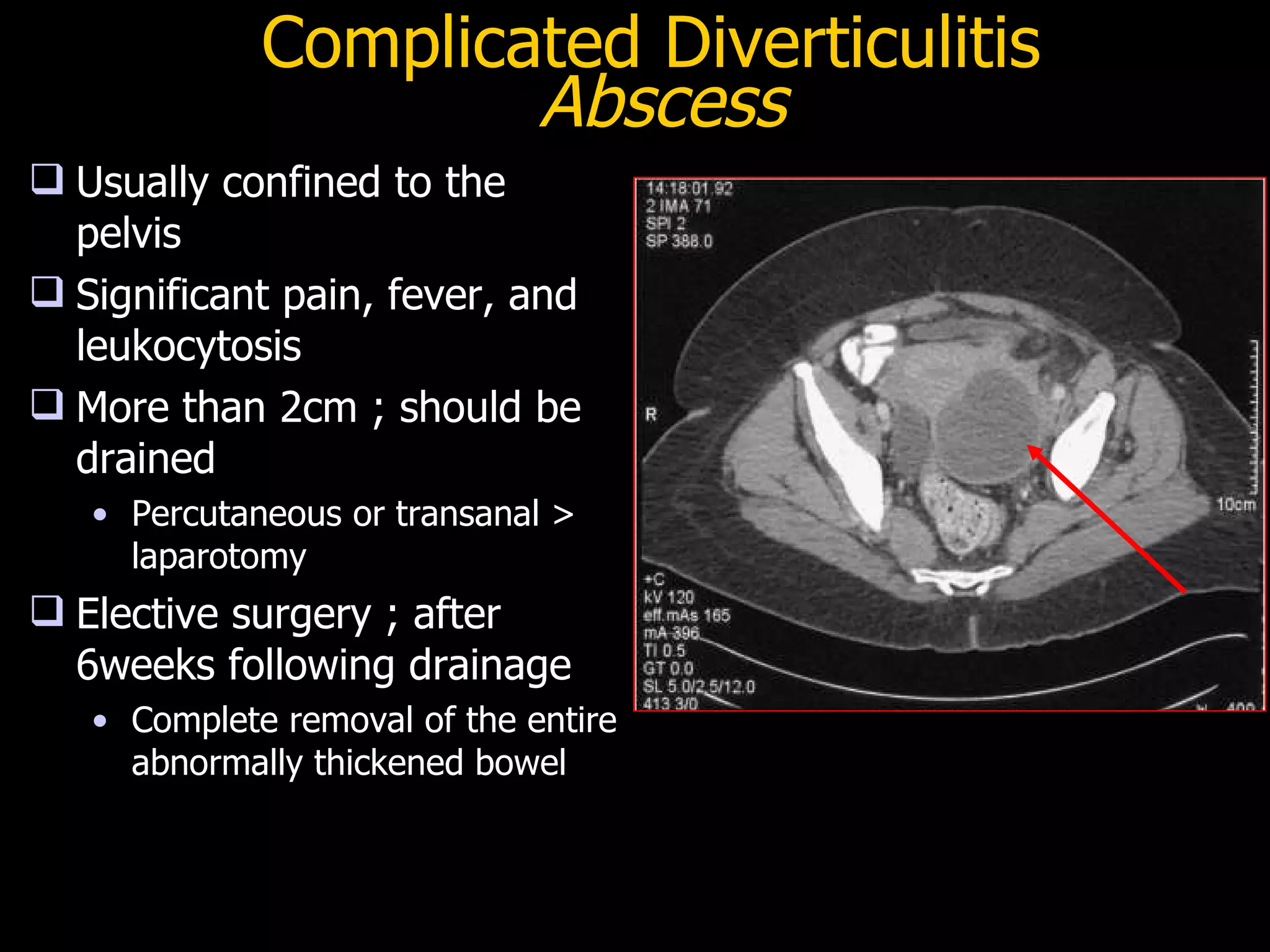 Diverticulitis | PPT