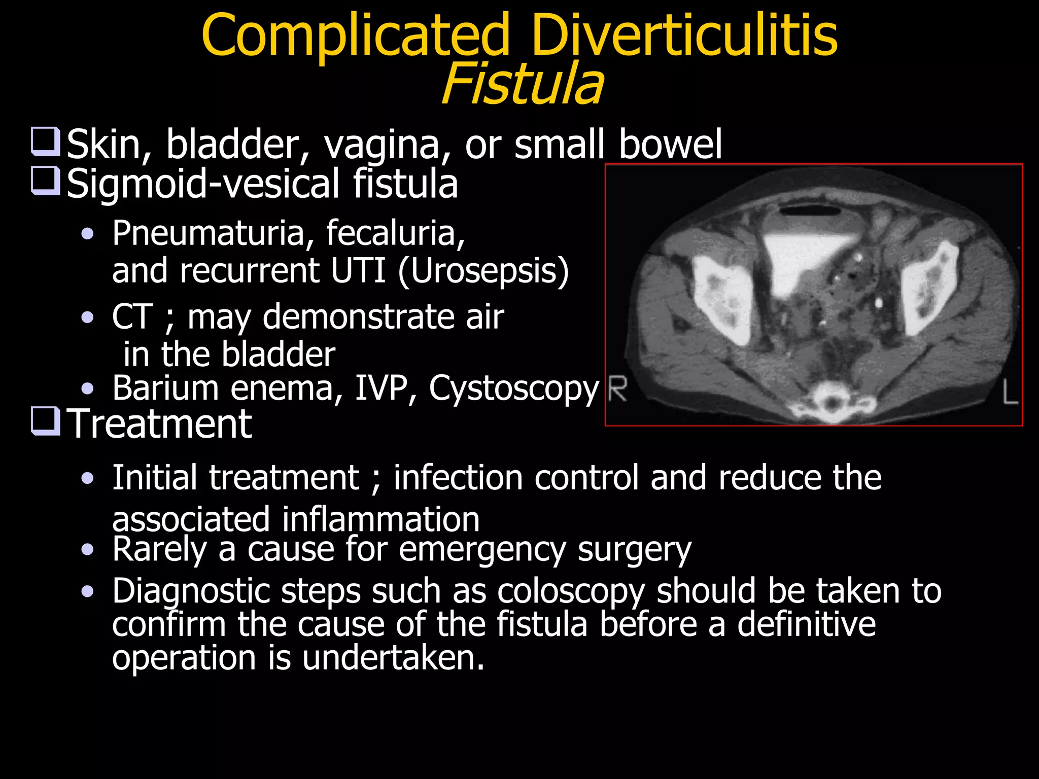 Diverticulitis | PPT