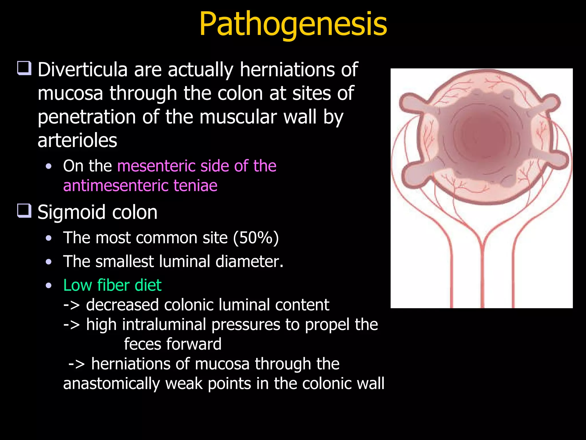 Diverticulitis | PPT