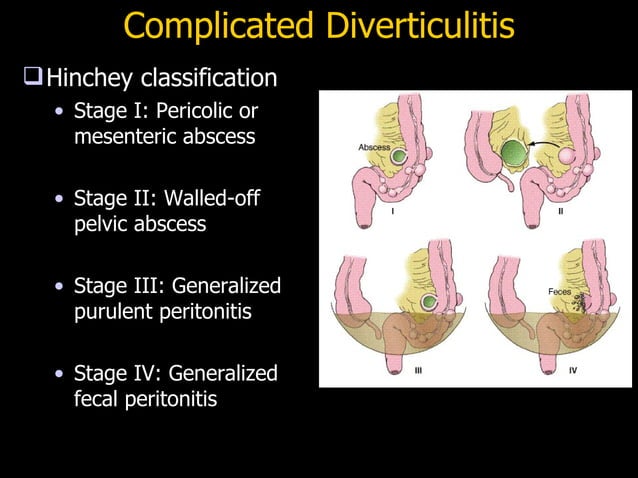 Diverticulitis | PPT | Digestive Disorders | Diseases and Conditions