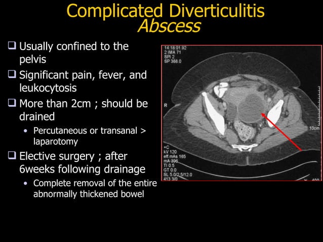 Diverticulitis | PPT | Digestive Disorders | Diseases and Conditions