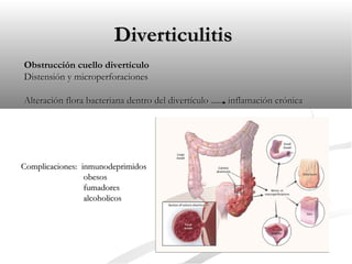 Diverticulitis | PPT
