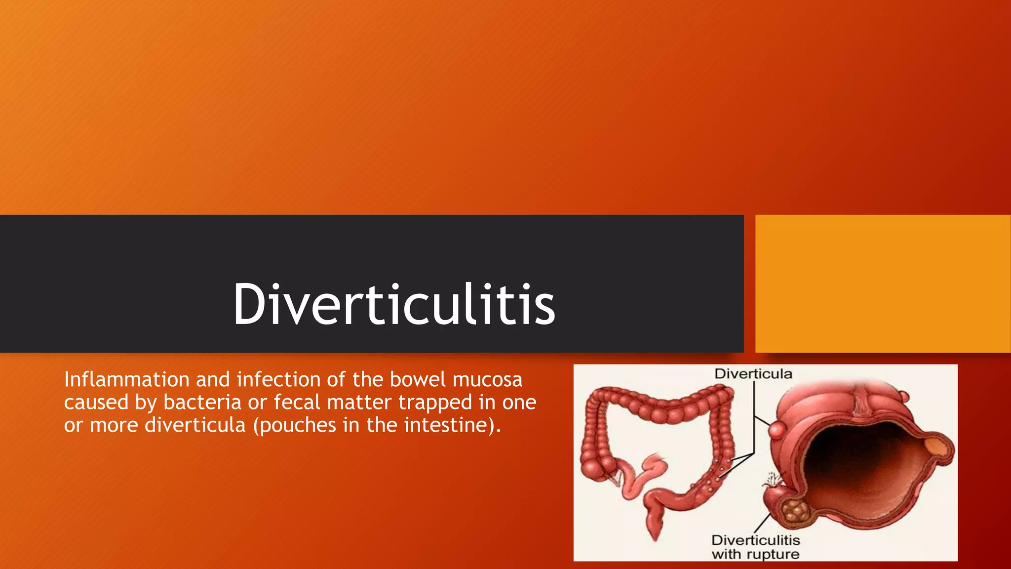 Diverticulitis | PPTX