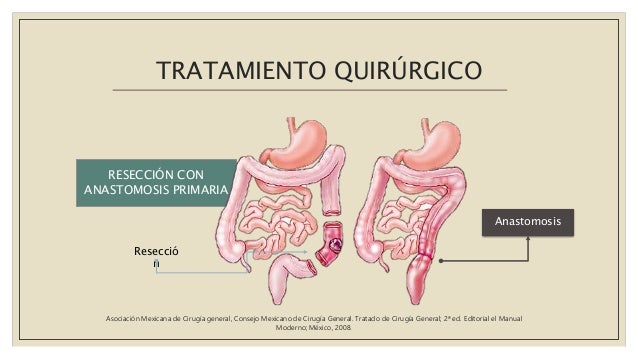 Diverticulitis