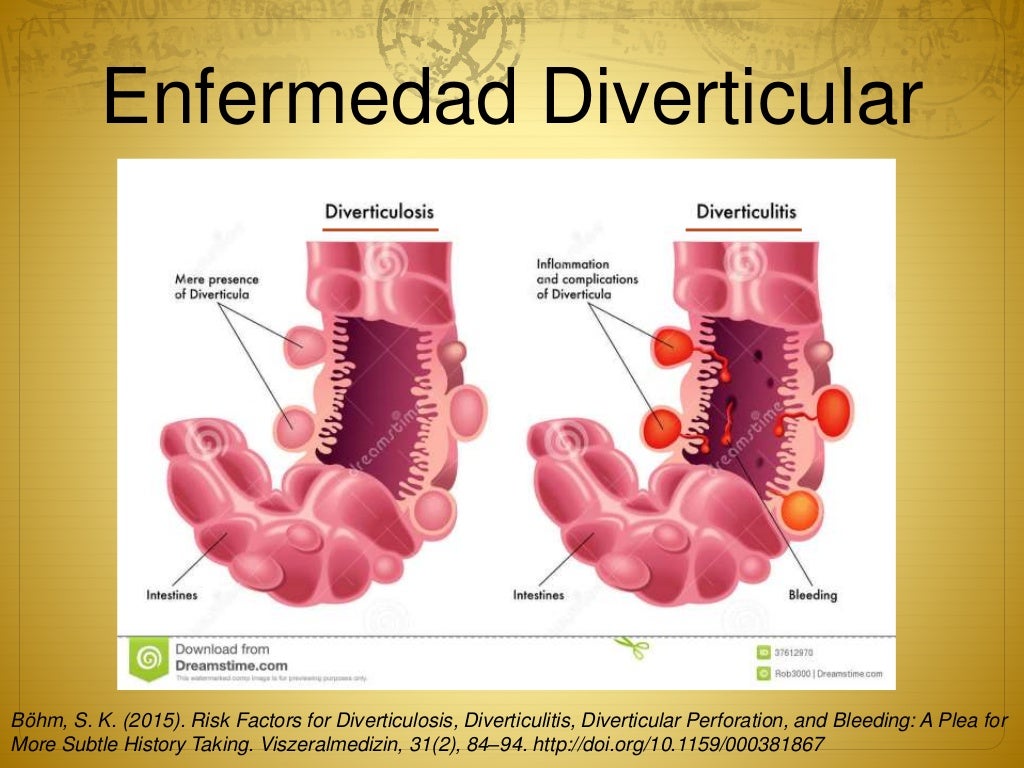 Enfermedad Diverticular Diverticulosis Diverticulitis Hemorragia D…