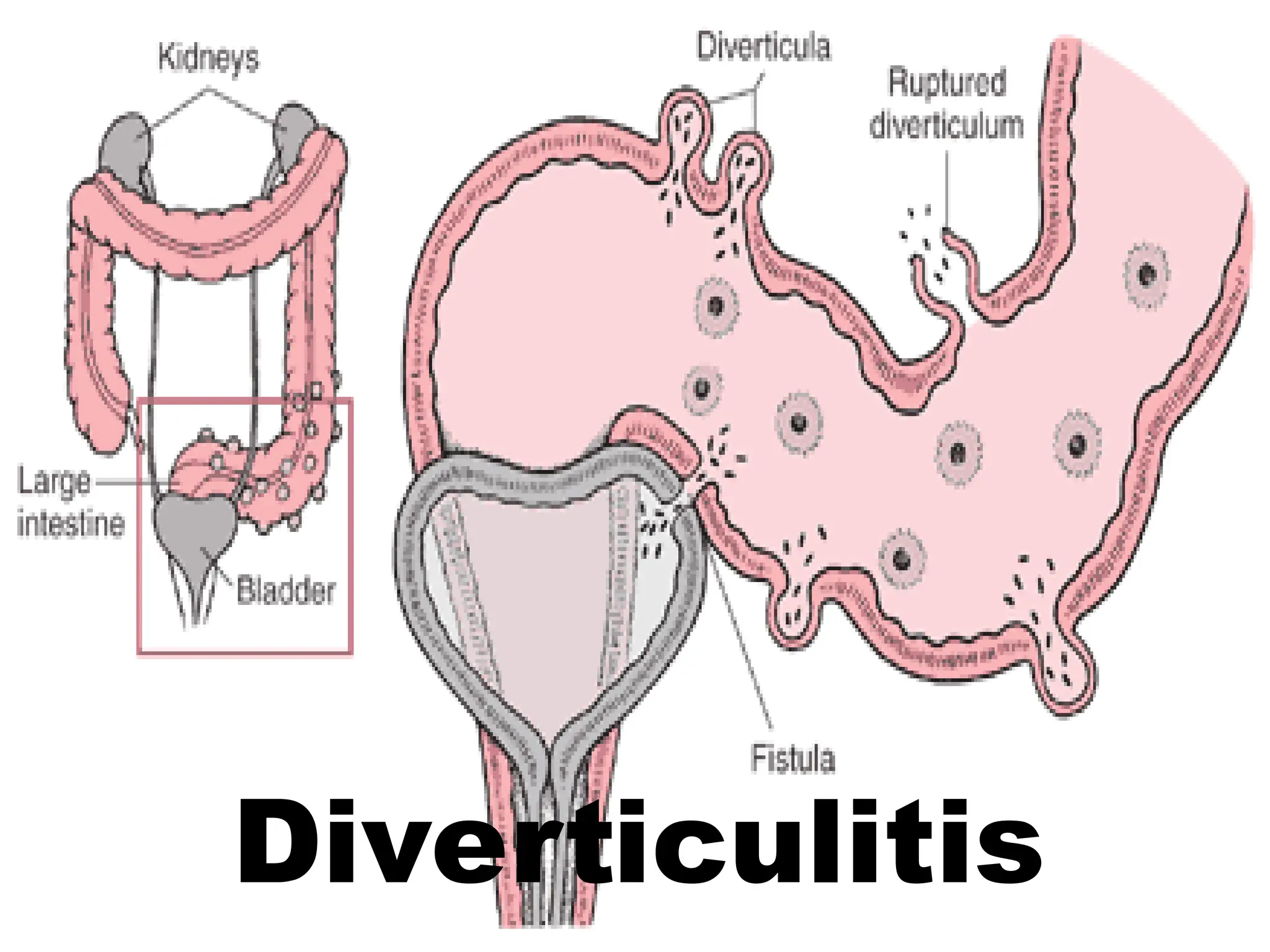Diverticulitis and its nursing management.ppt