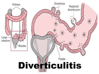 Diverticulitis and its nursing management.ppt