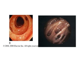 Diverticulitis and its nursing management.ppt