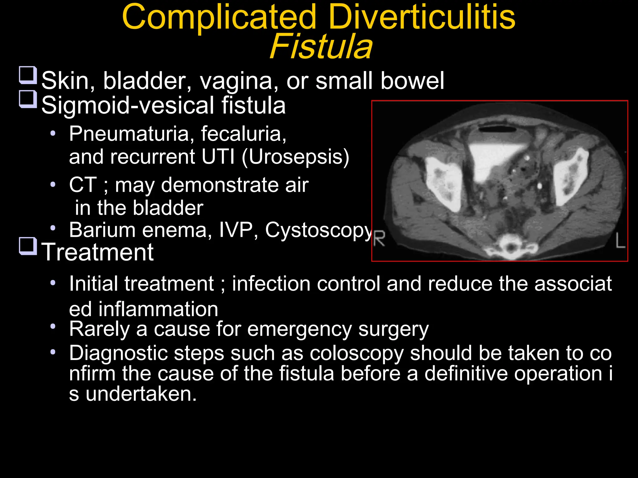 diverticulitis.pptkkkkkkkkkkkkkkkkkkkkkkkkkkkkkkkk | PPT