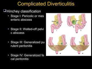 diverticulitis.pptkkkkkkkkkkkkkkkkkkkkkkkkkkkkkkkk | PPT
