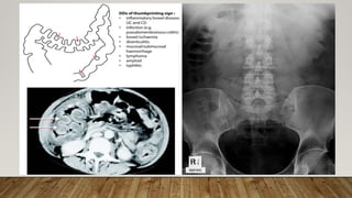 DIVERTICULITIS Types and management .pptx