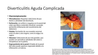 DIVERTICULITIS. DEFINICON , ANATOMIA, COMPLICACIONES | PPTX