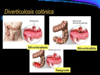 Diverticulitis colonica | PPT