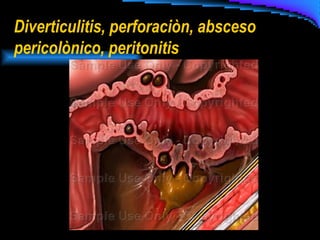 Diverticulitis colonica | PPT