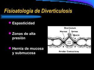 Diverticulitis colonica | PPT