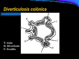 Diverticulitis colonica | PPT
