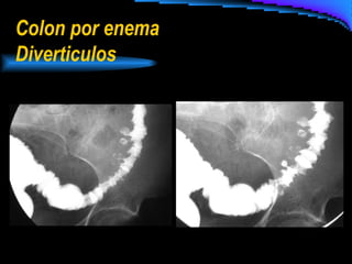 Diverticulitis colonica | PPT