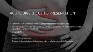 Diverticulitis Journal Club Presentation | PPTX