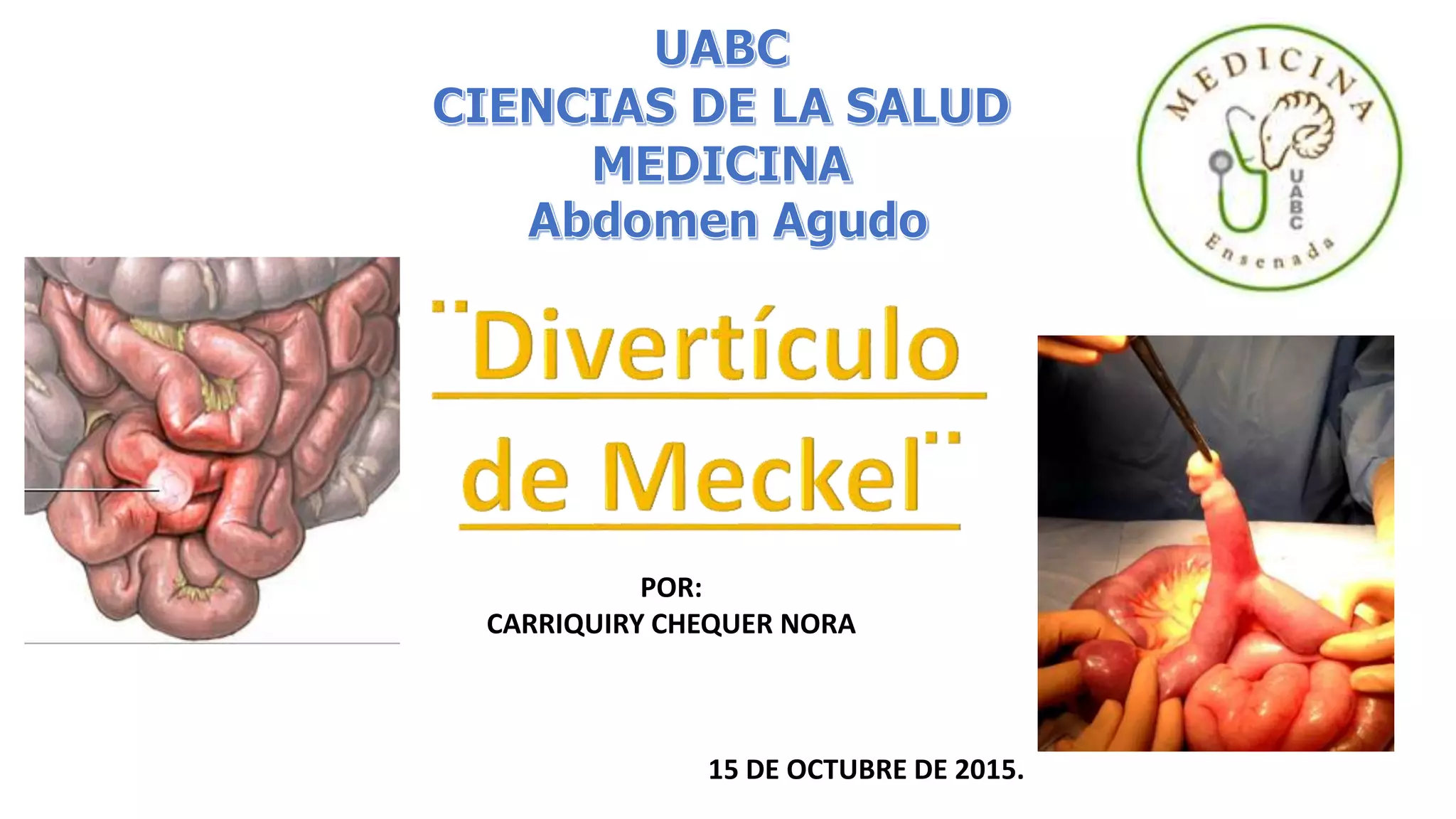 Diverticulo de meckel | PPTX