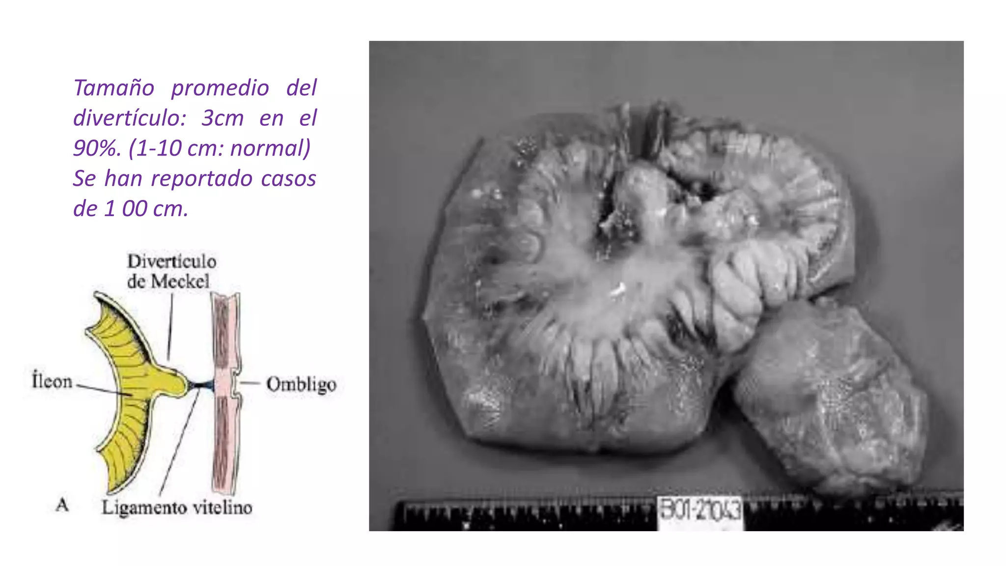 Diverticulo de meckel | PPTX