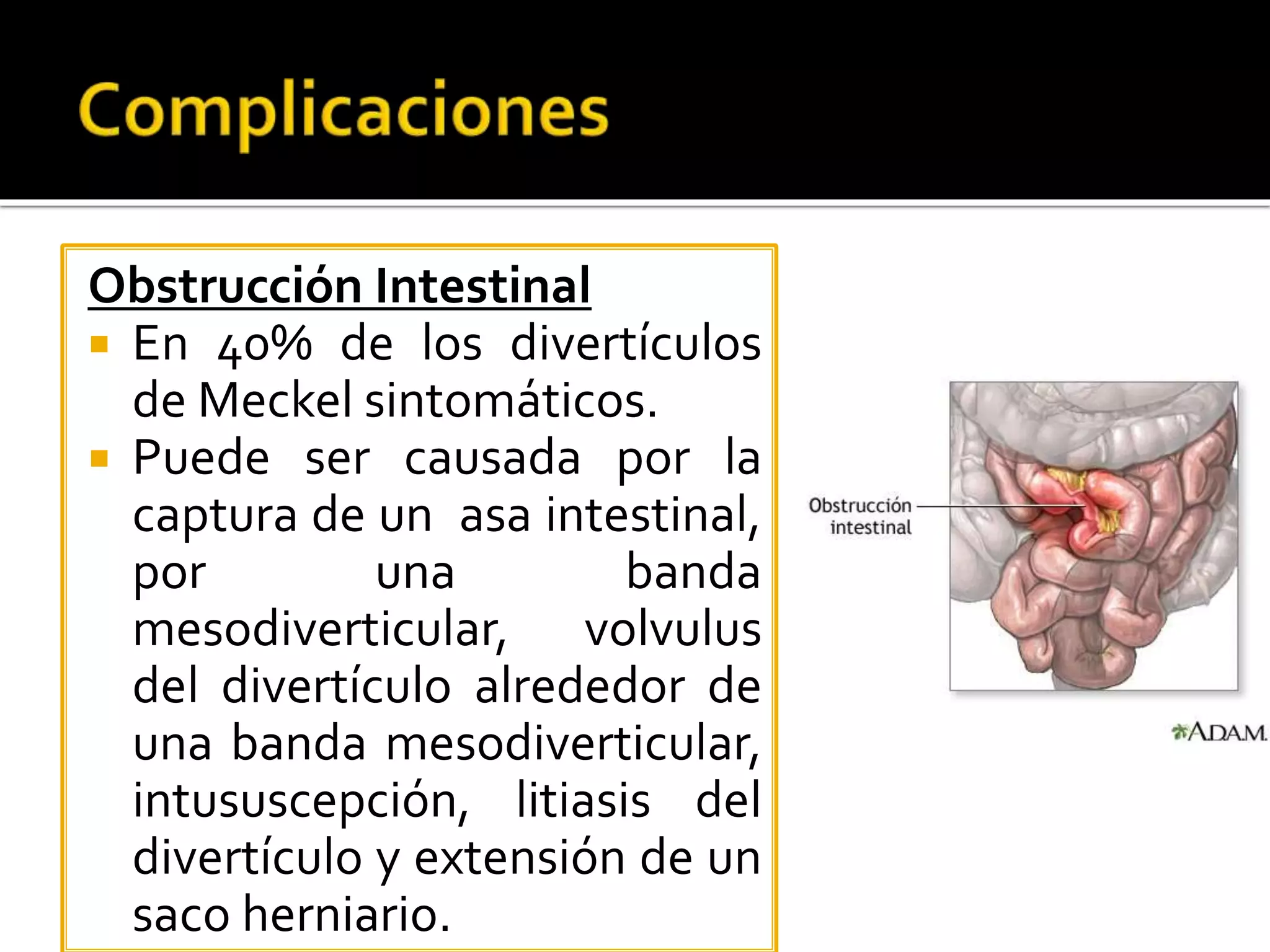 Diverticulo de meckel | PPTX