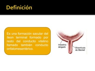Diverticulo de meckel | PPTX