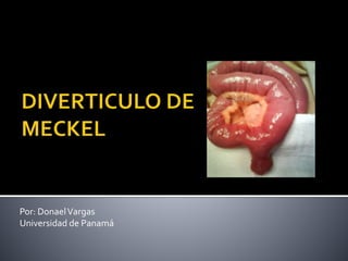 Diverticulo de meckel | PPT