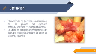 Divertículo de Meckel | PDF