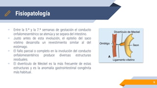 Divertículo de Meckel | PDF