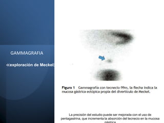 DIVERTICULO DE MECKEL PRESENTACION POWER POINT | PPT
