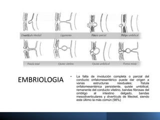 DIVERTICULO DE MECKEL PRESENTACION POWER POINT | PPTX