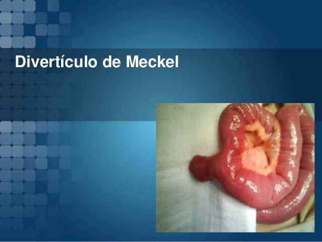 Diverticulo de meckel diverticulosis- divertiulitis (1)