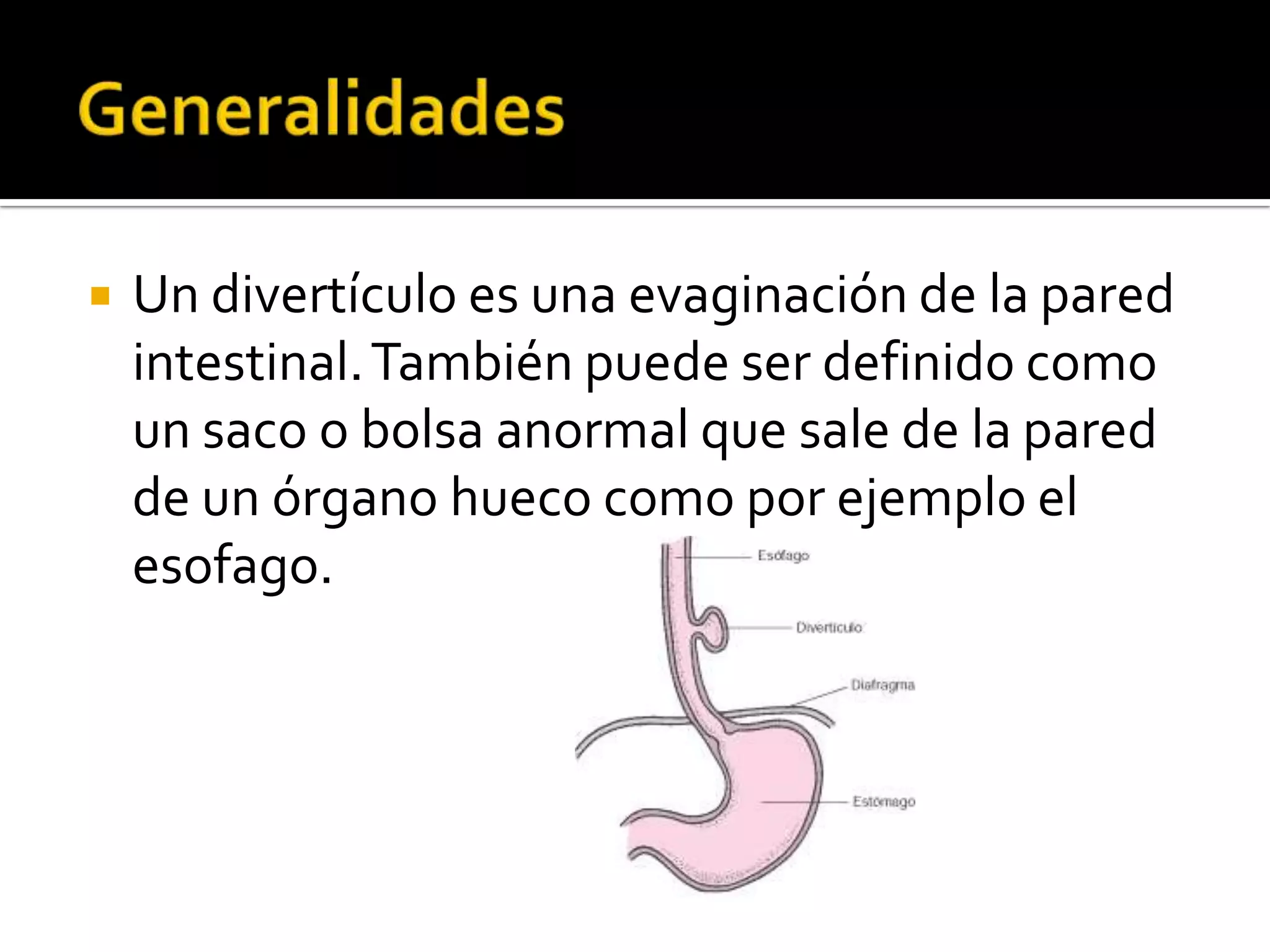 Diverticulos esofagicos | PPTX