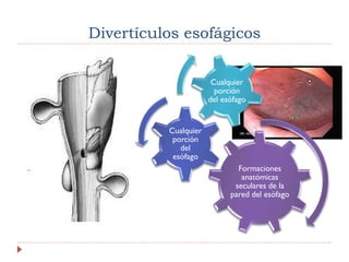 Diverticulos Esofagicos, Hospital General Balbuena | PPTX