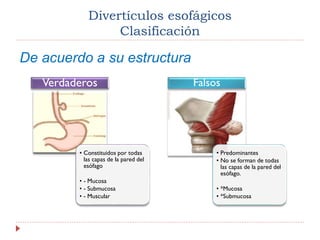 Diverticulos Esofagicos, Hospital General Balbuena | PPTX