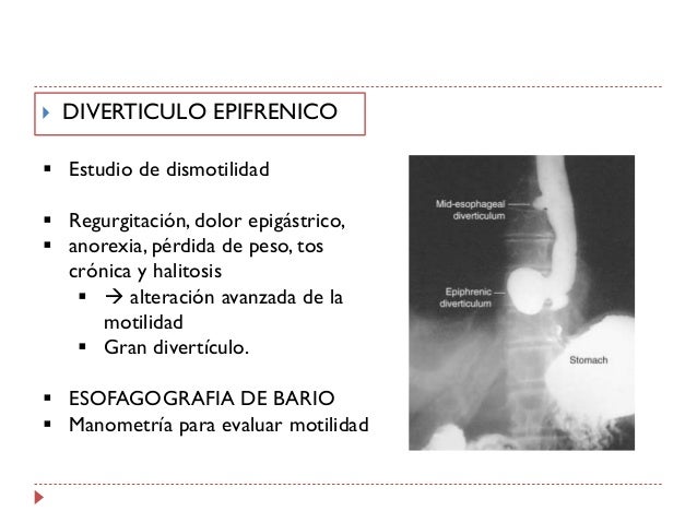 Diverticulo Epifrenico